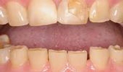 Bruxisme; bruxomanie; brycomanie